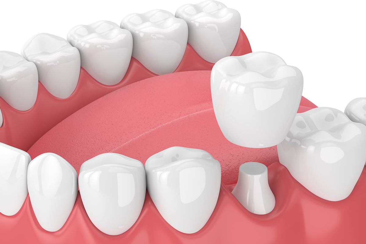 How Long Should Your Tooth Be Sensitive After Getting a Dental Crown ...